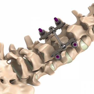 SPINAL STABILIZATION SYSTEM ( I SHAPED ) – ADITUS