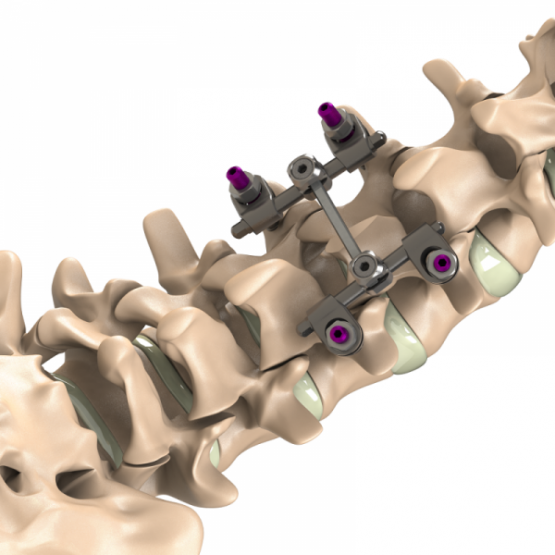 SPINAL STABILIZATION SYSTEM ( I SHAPED ) – ADITUS