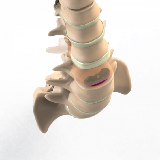 ADITUS LUMBAR DISC PROSTHESIS – ADITUS