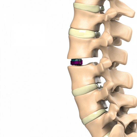 ADITUS LUMBAR DISC PROSTHESIS – ADITUS