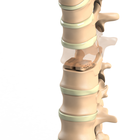 ADITUS LUMBAR PLIF CAGE – ADITUS