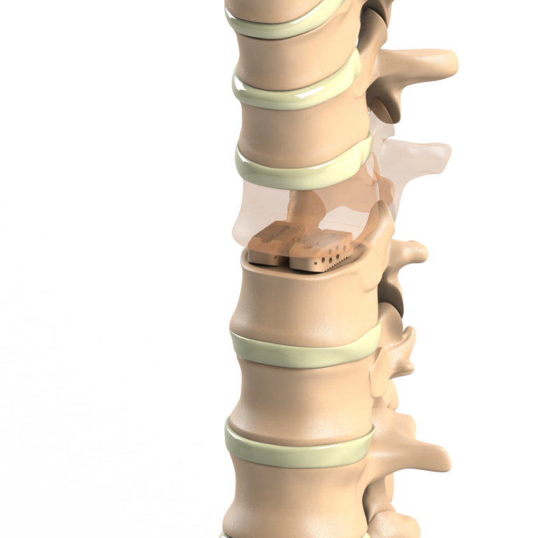 ADITUS LUMBAR PLIF CAGE – ADITUS