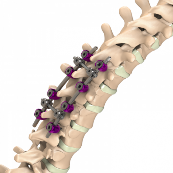 ADITUS SPINAL STABILIZATION SYSTEM – ADITUS