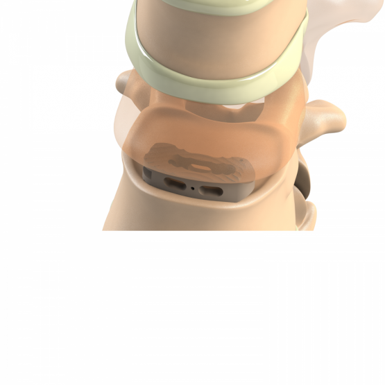 ADITUS LUMBAR TLIF CAGE – ADITUS