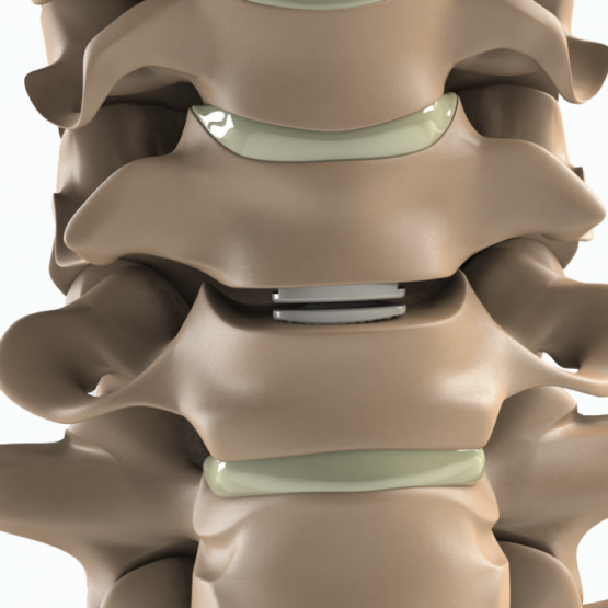 ADITUS CERVICAL DISC PROSTHESIS – ADITUS