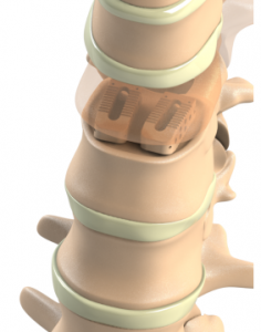 lumbar plif cage – ADITUS