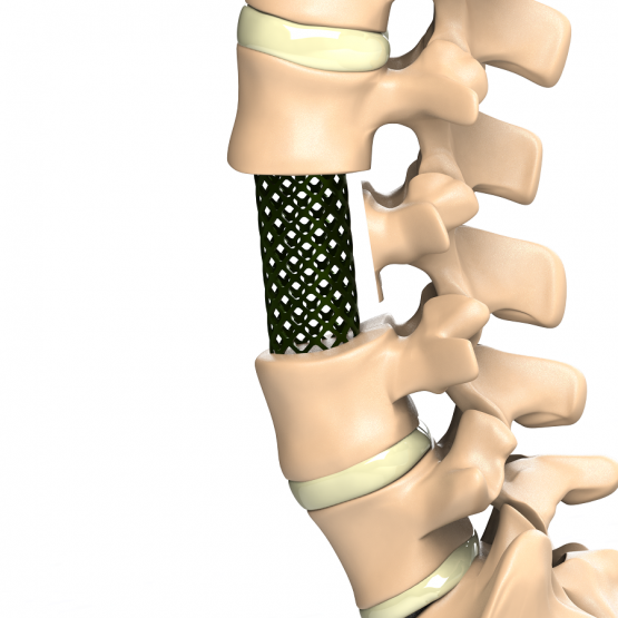 VERTEBRAL BODY REPLACEMENT – ADITUS